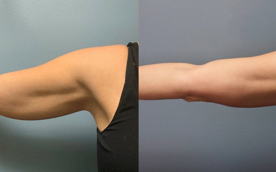 New Before and After section for Evolve X – Arns-muscle-tone | Age ...